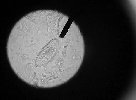 Enterobíase ou oxiuríase